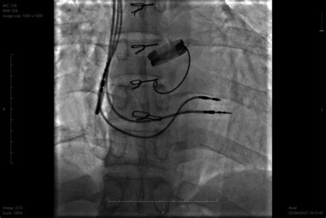 Final Resultsuccessfully Implanting New RV Lead On The Low Anterior Download Scientific