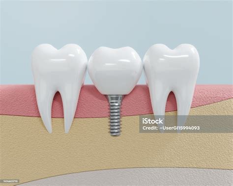 치과 임플란트 수술 개념 치과 의치 파란색 배경에 잇몸에 치과 의치 3d 렌더링 이빨에 대한 스톡 사진 및 기타 이미지 이빨 디지털 생성 이미지 잇몸 Istock