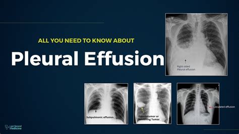 Pleural Effusion X Ray