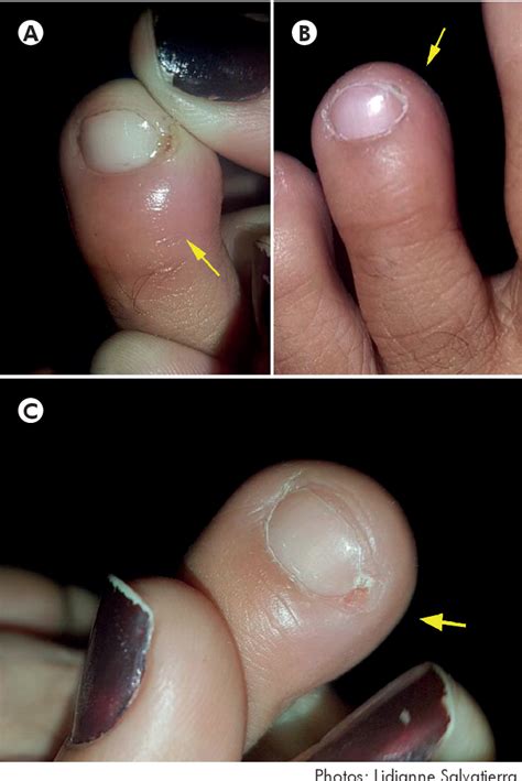 Brazilian Wandering Spider Bite Effect