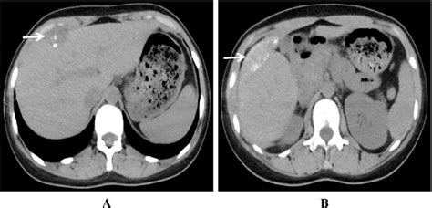 Serohepatic Type Non Enhanced Ct Scan Of The Abdomen Shows Coalesced