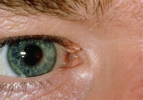 I Have Something On My Eyelid I Think Its A Wart Im Not Sure How