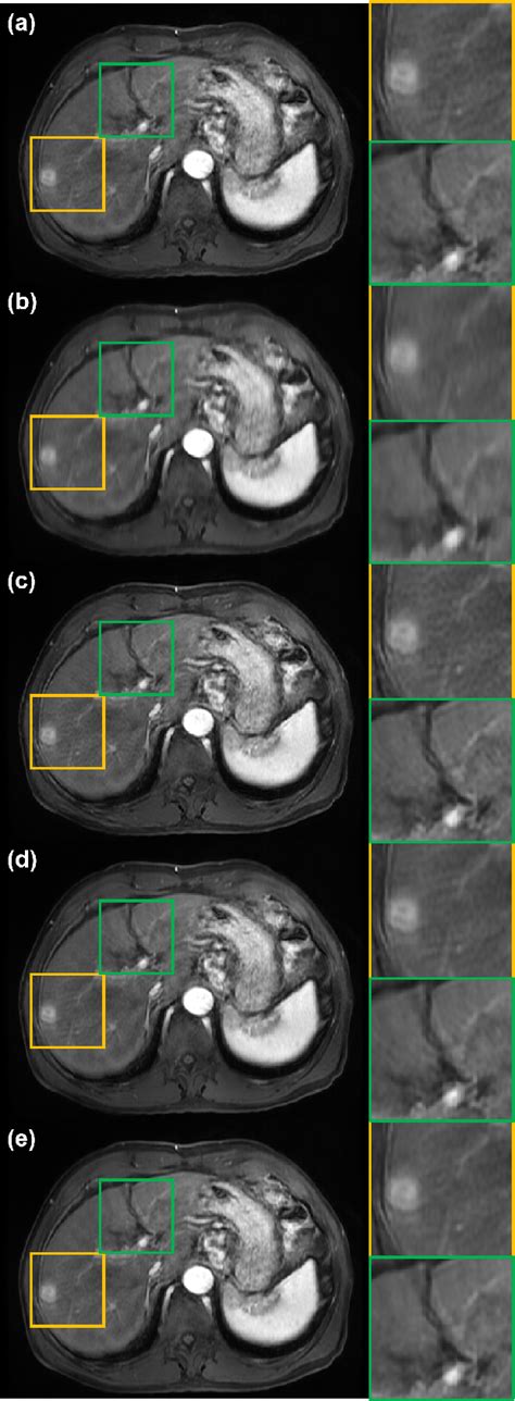 Figure 1 From Annealed Score Based Diffusion Model For Mr Motion Artifact Reduction Semantic