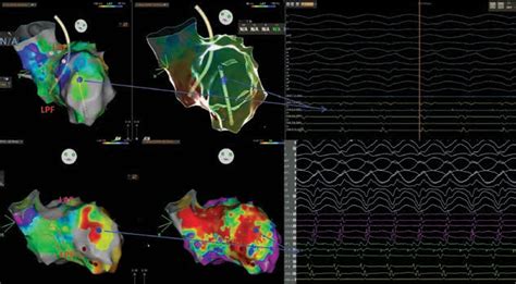 Figure 1 From The Initial Part Of Polymorphic Ventricular Tachycardia