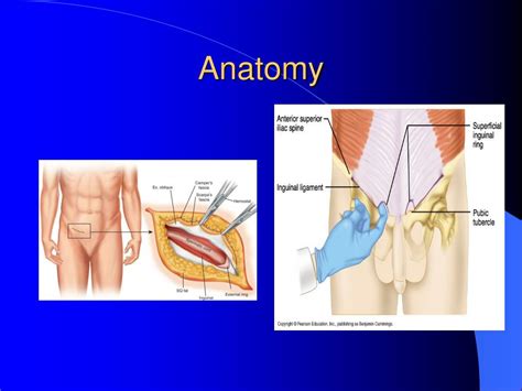 Ppt Hernia Powerpoint Presentation Free Download Id2275910