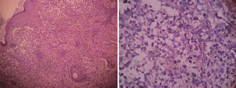 A Dense Infitration Of Histiocytes Throughout The Dermis B High Download Scientific