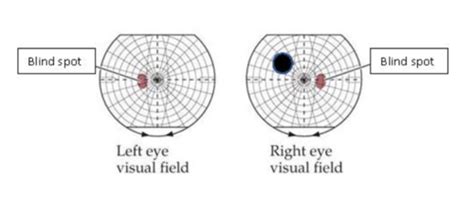 Visual Field Defects Flashcards Quizlet