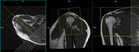 Shoulder Mri Planning Mri Shoulder Protocols Indications For Mri Shoulder Scan
