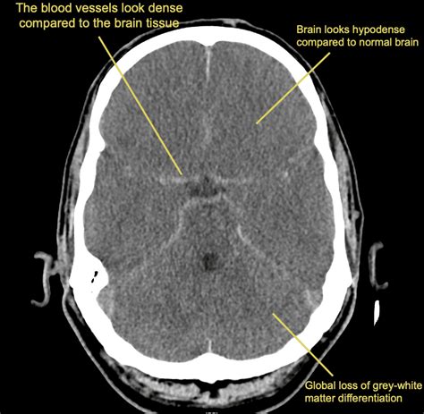 Ct Case 011 • Litfl • Ct Scan Interpretation