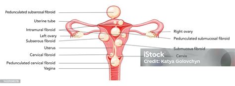 자궁 근종 여성 평활근종 생식 시스템 자궁 다이어그램 라틴어 텍스트에 비문과 함께 인간 해부학 의료 삽화 고립 된 내부 장기 위치 구성표 자궁 경부 평면 아이콘 다이어그램에