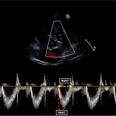 A Spectral Doppler Signal Across PDA With Continuous Left To Right Download Scientific Diagram