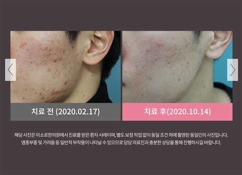 여드름 자국흉터 미소로한의원 광주점