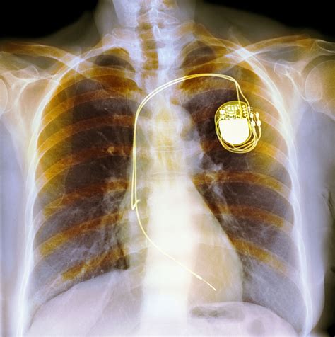 Implantable Cardioverter Defibrillator Complications
