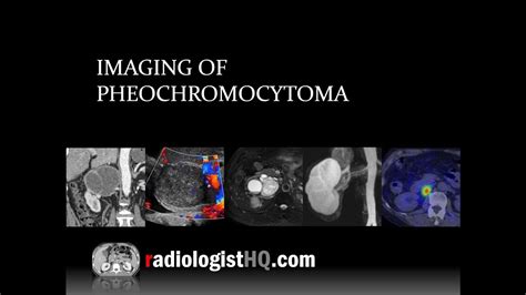 Imaging Of Pheochromocytoma YouTube