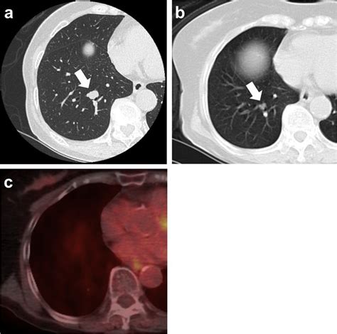 12mm Nodule Lung