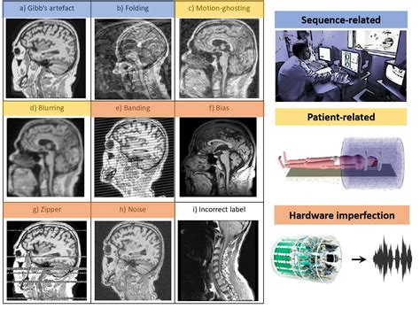 Recognition Of Artifacts In Mris Ai Healthlab