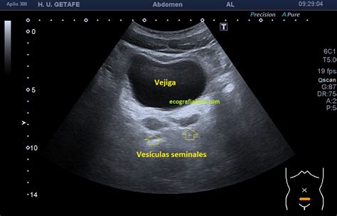 Vesícula Seminal Ecografía Fácil