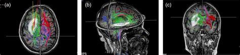 Dti Diffusion Tensor Imaging Shows The Spatial Relationships Between