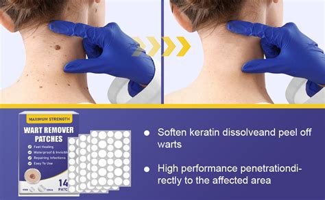 Wabriny Maximum Strength Wart Remover Patches Fast And Easy