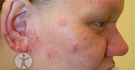 Photodermatitis Polymorphic Light Eruption Image