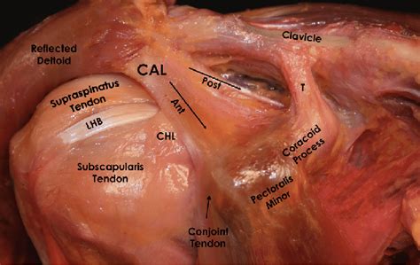 Cadaveric Image Of A Right Shoulder With The Deltoid Reflected The