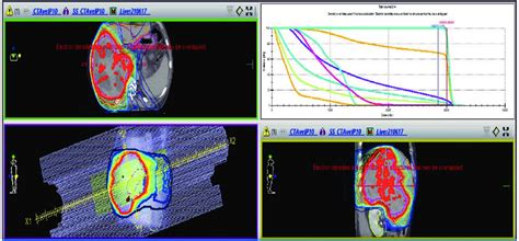 Simultaneous Integrated Boost Radiotherapy And Intensity Modulated Download Scientific Diagram