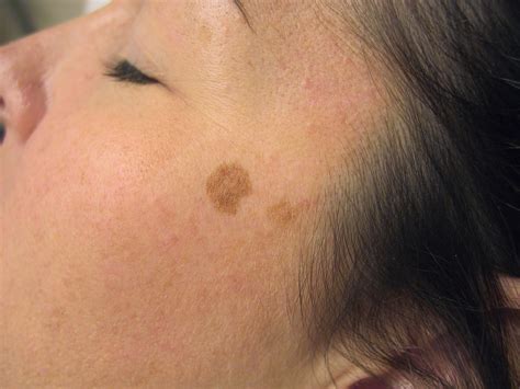 Skin Disease Types Lentigo Simplex Skin Disease Type