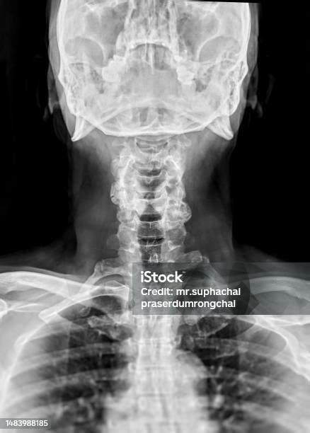 Xray Cspine Or Xray Image Of Cervical Spine Lateral View For Diagnostic Intervertebral Disc