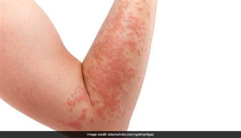 Leukemia Rash Face Polymorphous Light Eruption Lupus