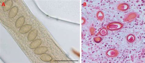 Capillaria Hepatica Scheda Parassitologica E Approfondimenti