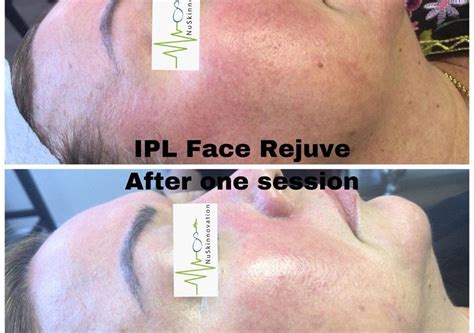 Diffused Redness NuSkinnovation PTY LTD Laser Skin Clinic