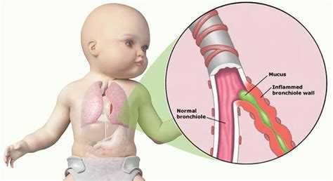 Amri Hospitals Bronchiolitis Types Causes And Symptoms
