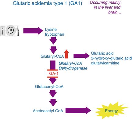 Nutrition Management Of Glutaric Acidemia Type 1 Springerlink