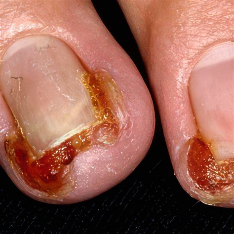 Toenail Problems Causes Symptoms And Treatments