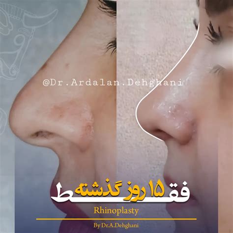 ‎دکتر اردلان دهقانی جراح بینی شیراز عمل بینی‎ ‎جراحی بینی مردانه