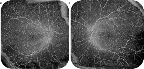 Wf Octa Of The Superficial Capillary Plexus Slab Of Case 3 Right Eye Download Scientific