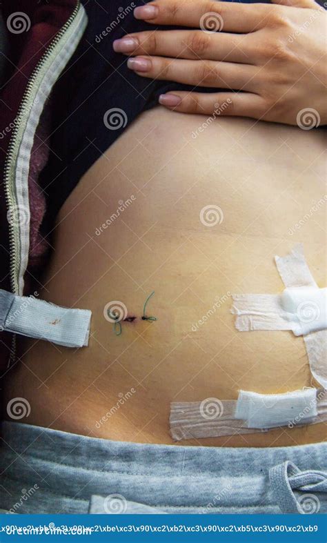 Examination Of The Patient By A Doctor After Removal Of The Appendix Selective Focus Stock Image