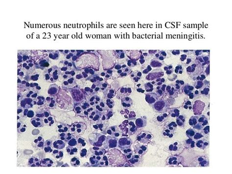 Fluid Cytology In Csf