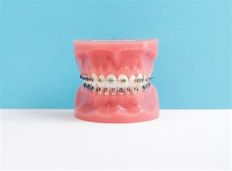 Metal Braces Should You Go Traditional « Smile Team Orthodontics Blog