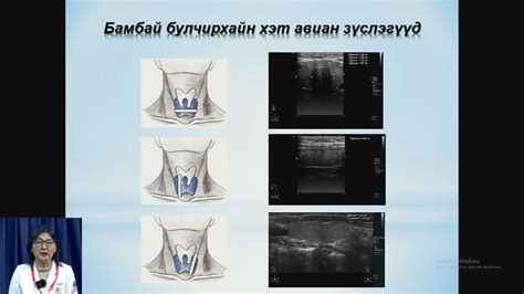 Бамбайн хэт авиа оношилгоо Youtube