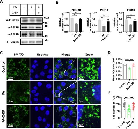 Pex11b Palmitoylation Couples Peroxisomal Dysfunction With Schwann Cells Fail In Diabetic
