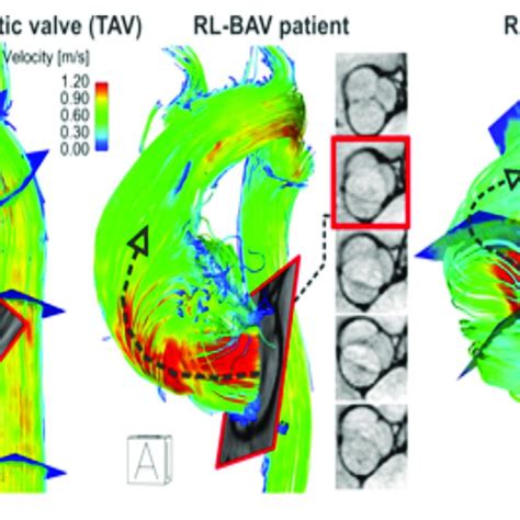 4d Flow And Wss Quantification In 15 Rn Bav Patients Found That 4d Flow Download Scientific