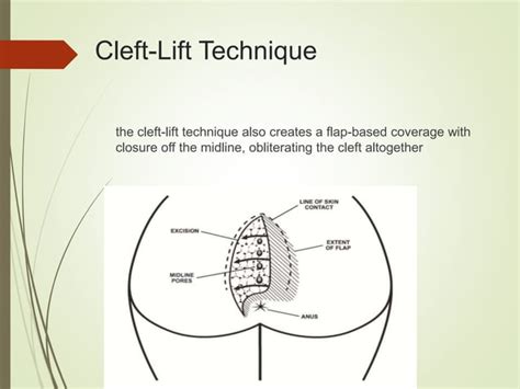 Pilonidal Disease Management Approach Pptx Ear Nose And Throat Conditions Diseases And