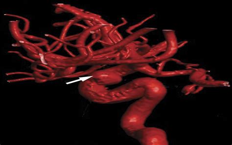 Pipeline Embolization Device A New Source For Embolic Retin Journal Of Neuro Ophthalmology