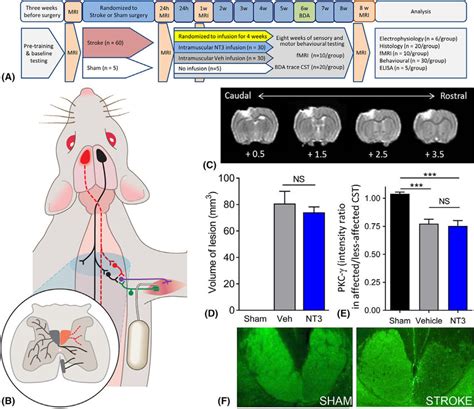 Focal Stroke Caused Unilateral Infarction In Sensorimotor Cortex