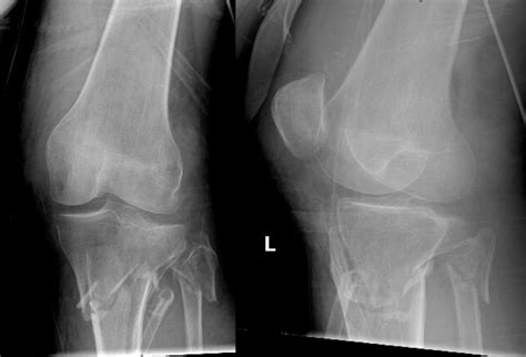 Proximal Tibial Fractures The Bone Babe