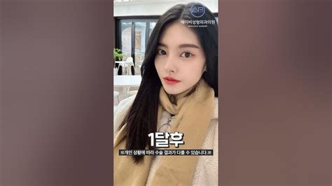 눈성형눈매교정뒤트임코성형복코짧은코 후기 Shorts Youtube