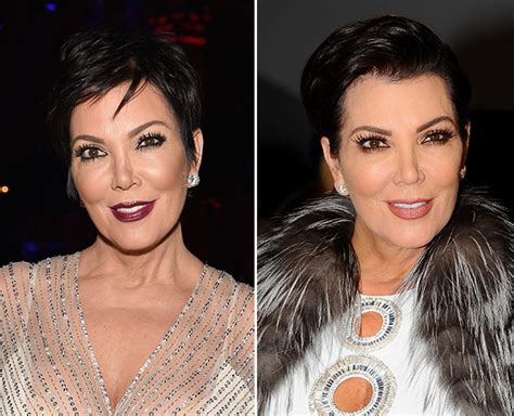 Kris Kardashian Facelift
