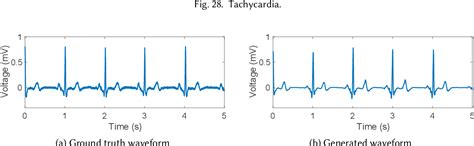Figure 29 From Ecg Grained Cardiac Monitoring Using Uwb Signals Semantic Scholar