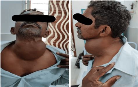 Tracheal Deviation Neck